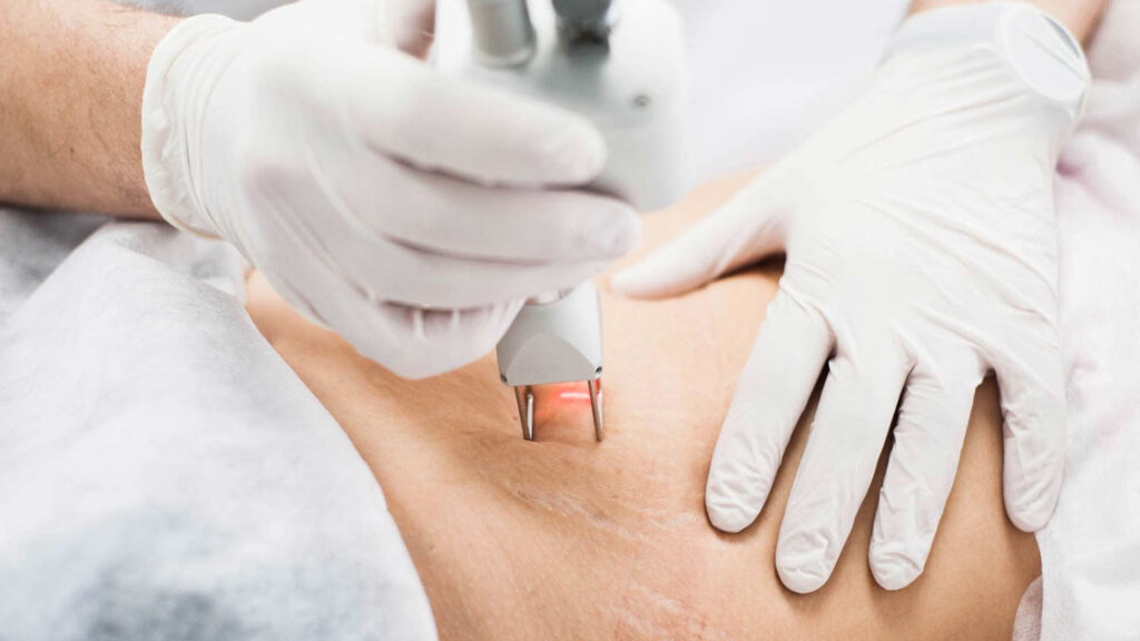 CO2 Laser Treatment Doral | Idealaser Cosmetic Center Of Miami